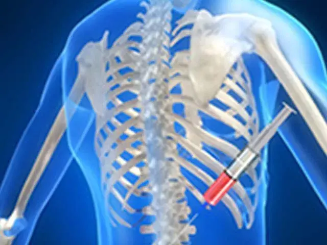 Epidural Injection Codes to Improve Pain Management Reimbursement