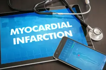 2018 ICD-10 Code Updates for Myocardial Infarction (MI)