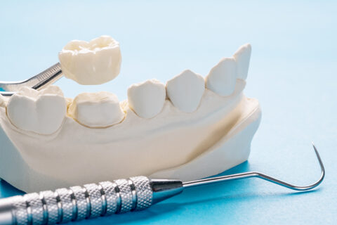 CDT Codes to Document Dental Bridge Procedure